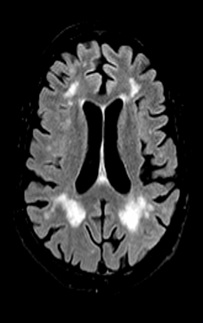 White Matter Hyperintensity and Vascular Disease from Biological Basis to Clinical Significance